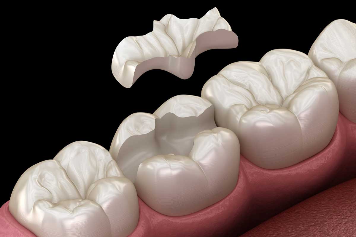 Dental Inlays In South Edmonton - Heritage Dental Centre