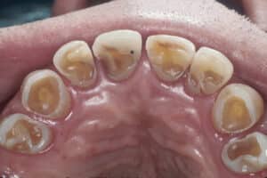 Preventing And Treating Exposed Dentin | Heritage Dental Centre