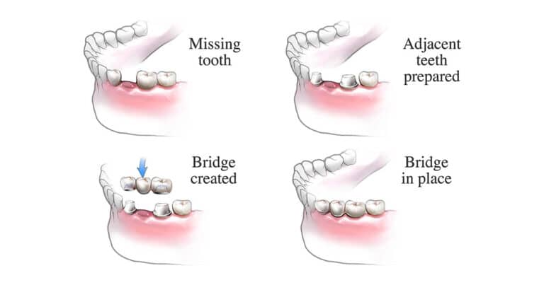 Understanding Dental Bridges: Solutions For Missing Teeth At Heritage ...