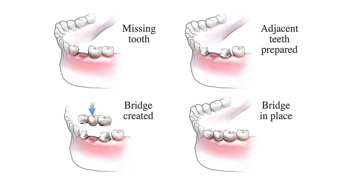 Understanding Dental Bridges: Solutions For Missing Teeth At Heritage ...